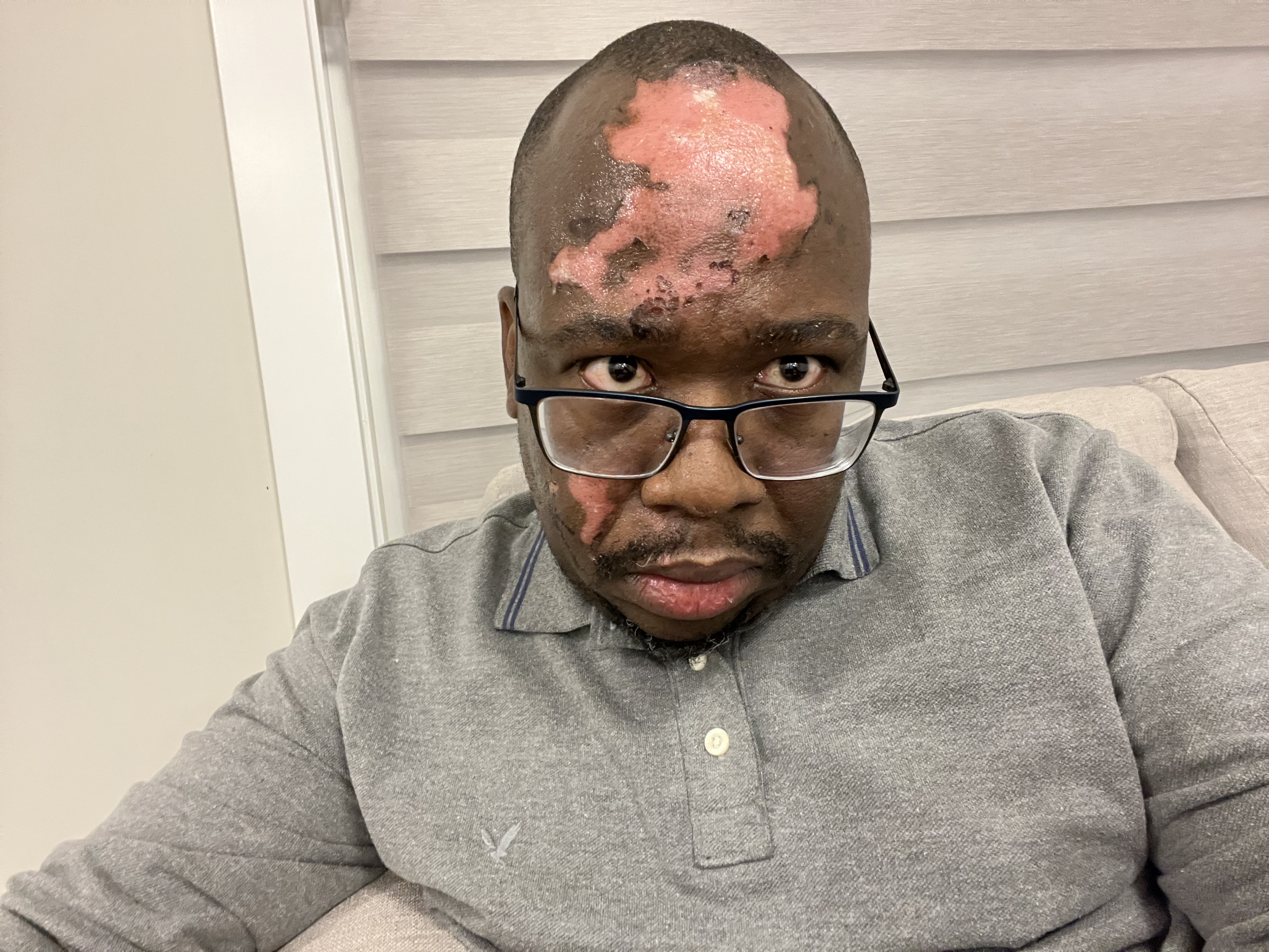 My Skin, My Story: How a Facial Burn Transformed My Understanding of ...