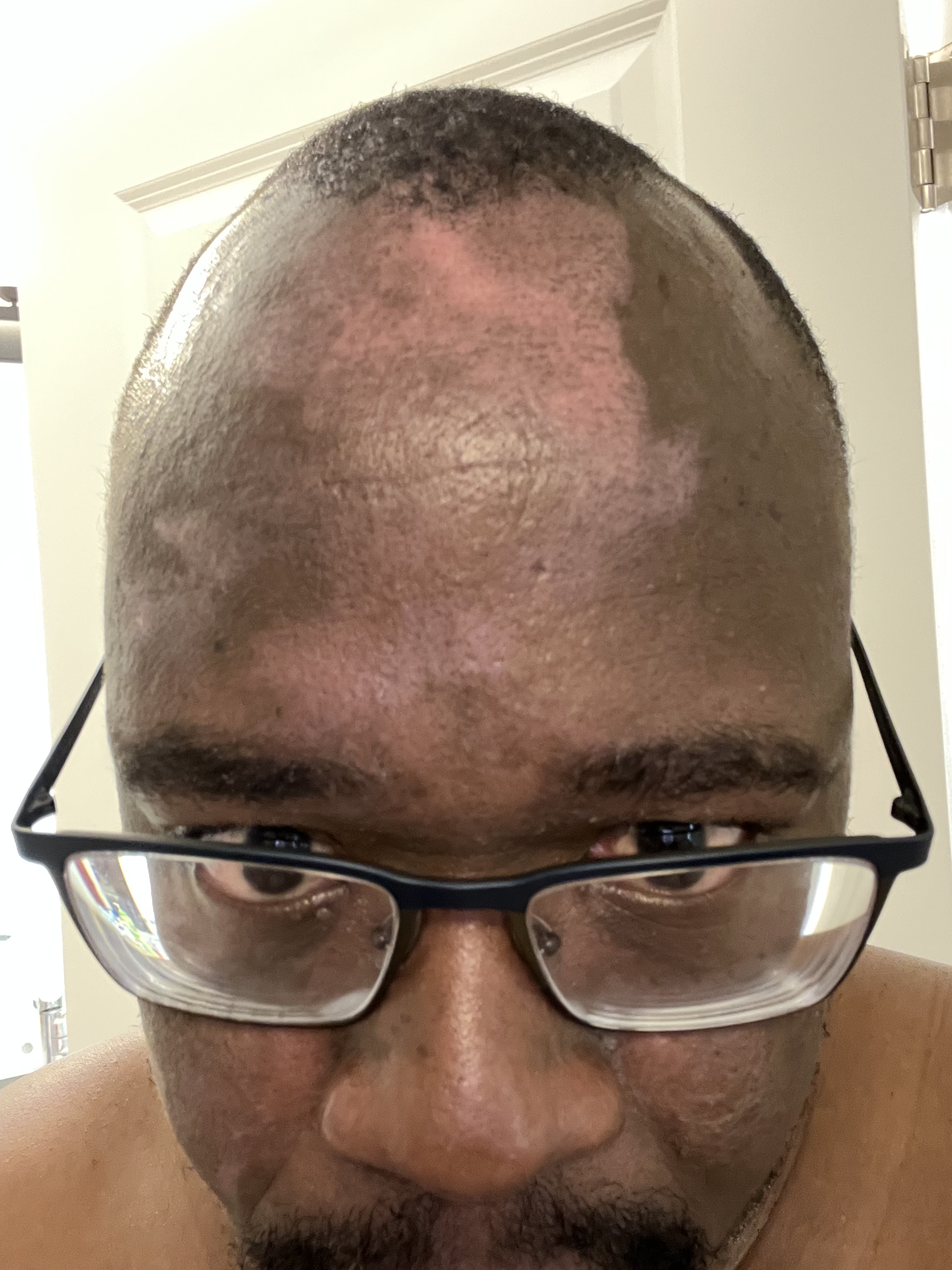 My Skin, My Story: How a Facial Burn Transformed My Understanding of ...